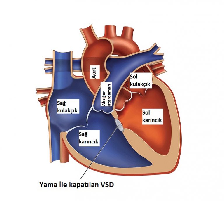 VSD (Ventriküler Septal Defekt) ve Tedavisi - Doç Dr Osman Özdemir